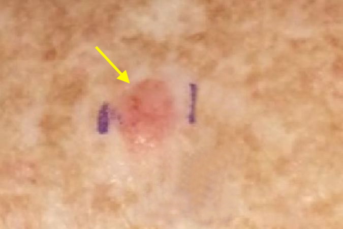 Basal Cell Carcinoma Hand Surgery Resource 1332